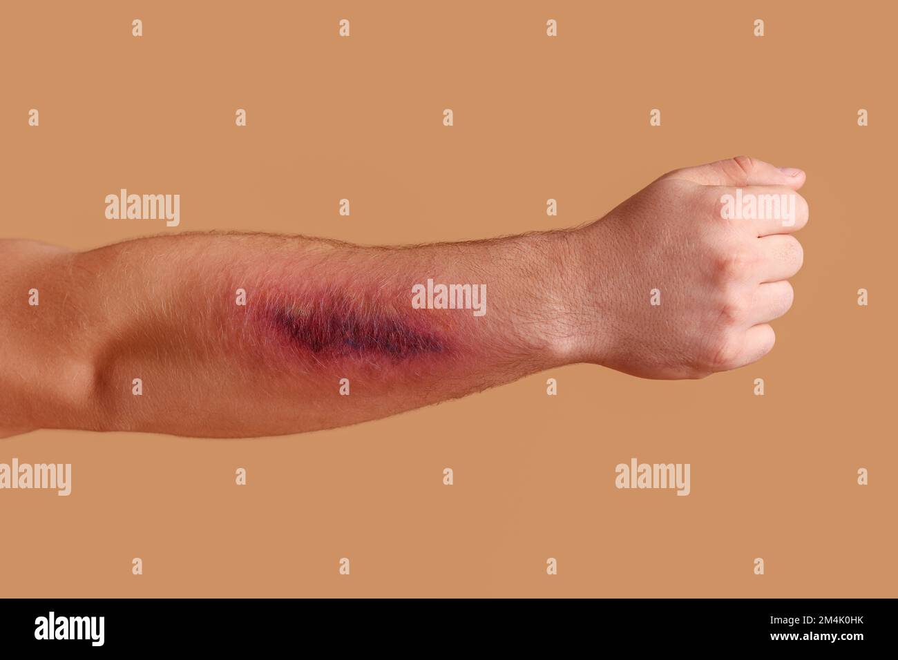 Male arm with bruise on beige background Stock Photo - Alamy