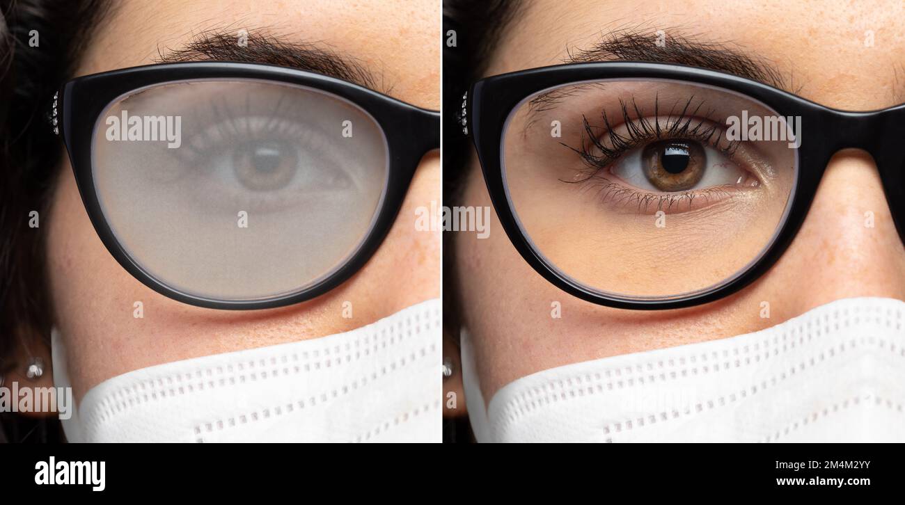 Before And After Comparison Of Fogged Glasses For Mask Use Closeup Of A Girls Eye With Steam