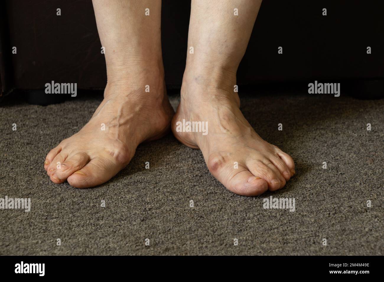 Varicose veins in legs hi-res stock photography and images - Alamy