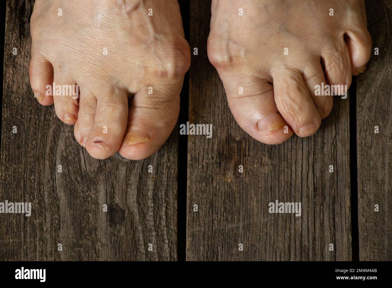 Varicose veins in legs hi-res stock photography and images - Alamy