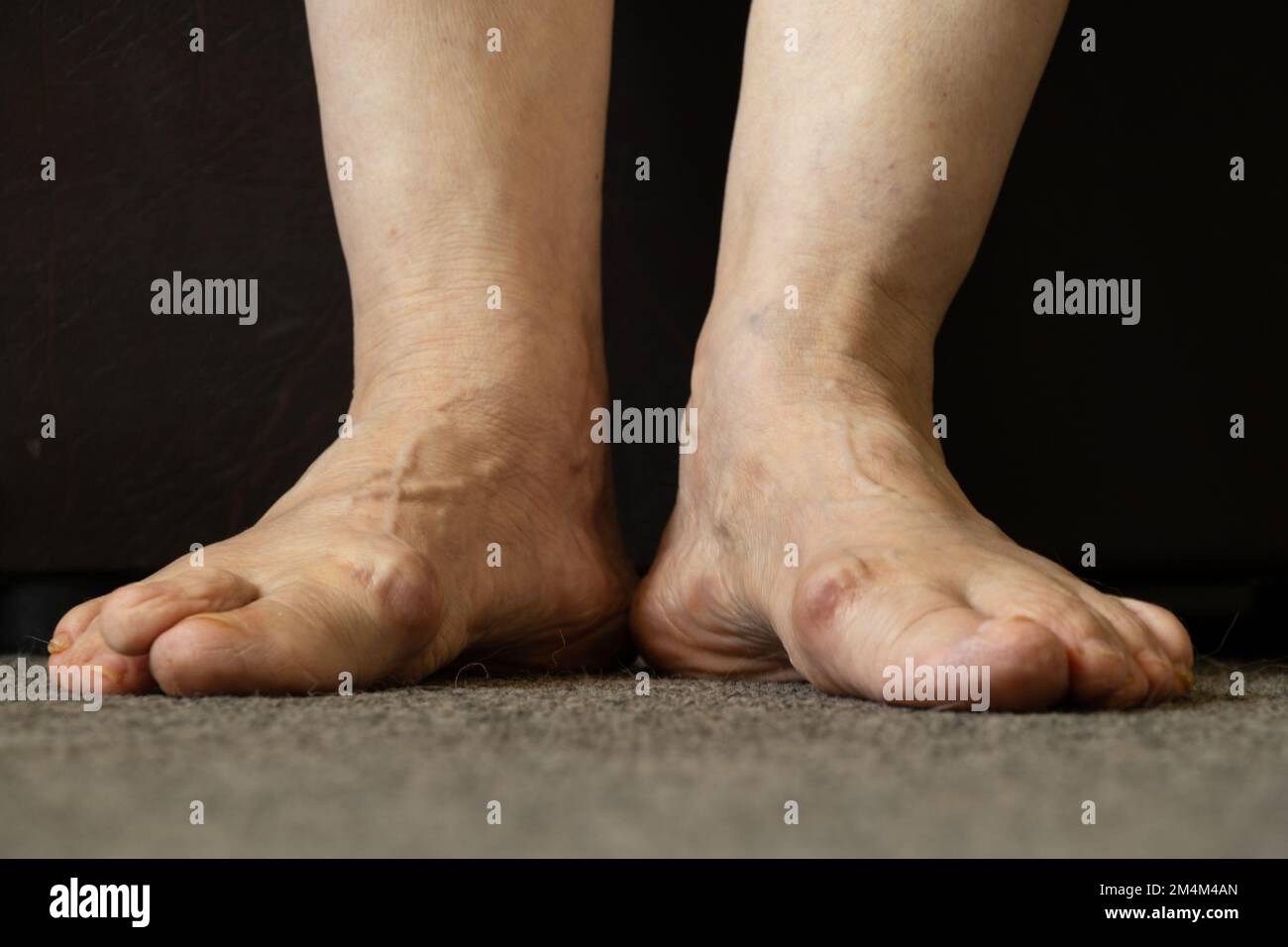 Varicose veins in legs hi-res stock photography and images - Alamy