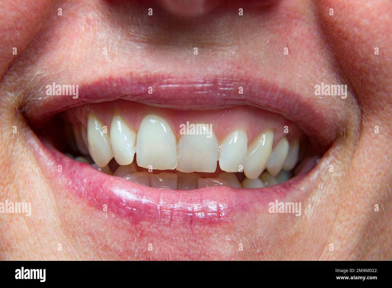 lower and upper denture with average smile. High quality photo Stock ...