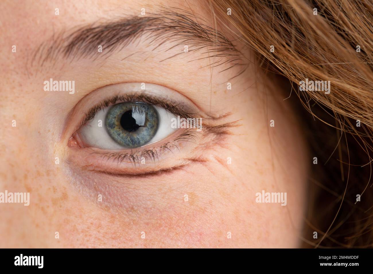 eye bags close up on woman face. High quality photo Stock Photo - Alamy