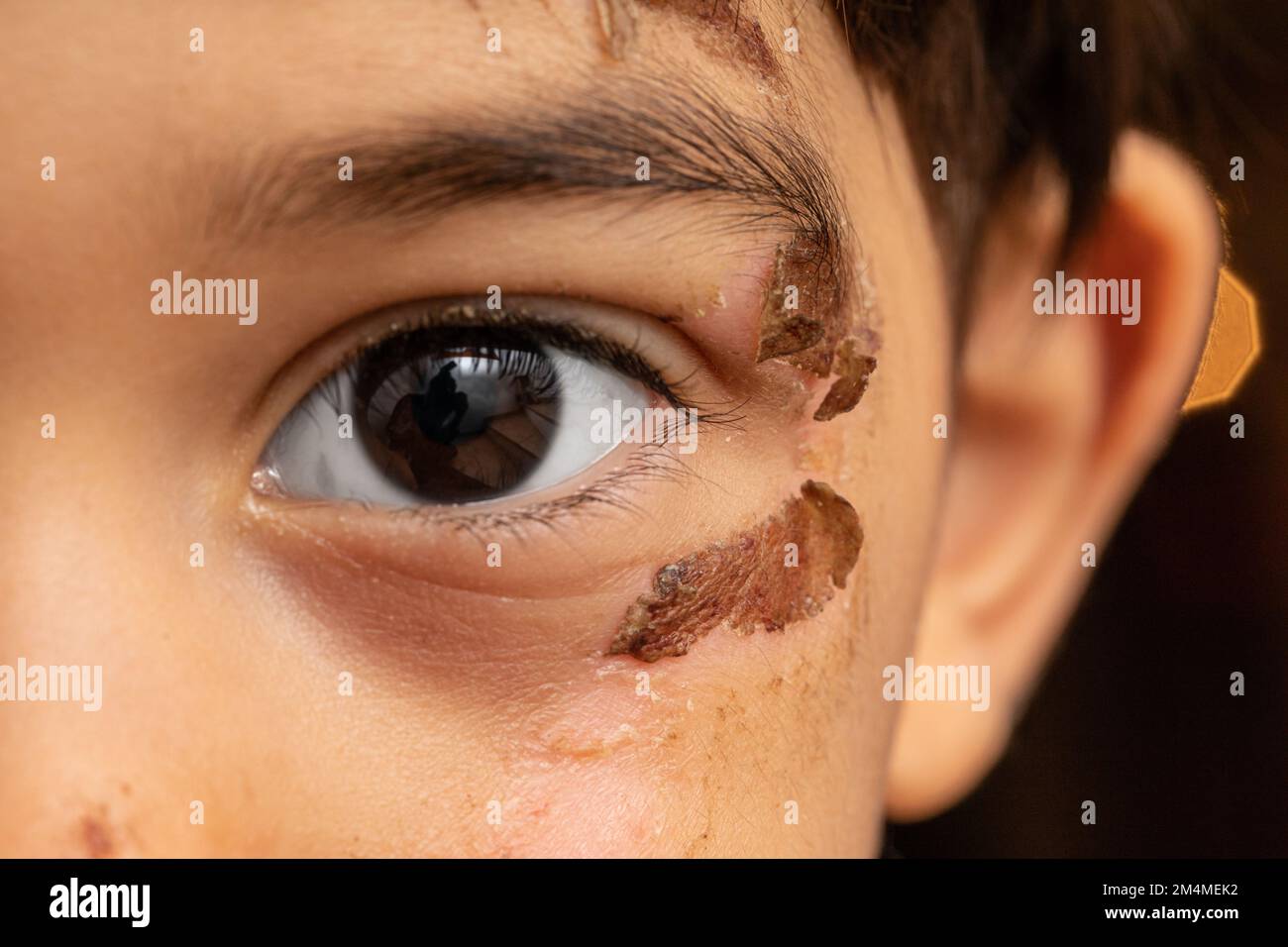Macro of a child's eye with abrasions near the temple. Crusts that are ...