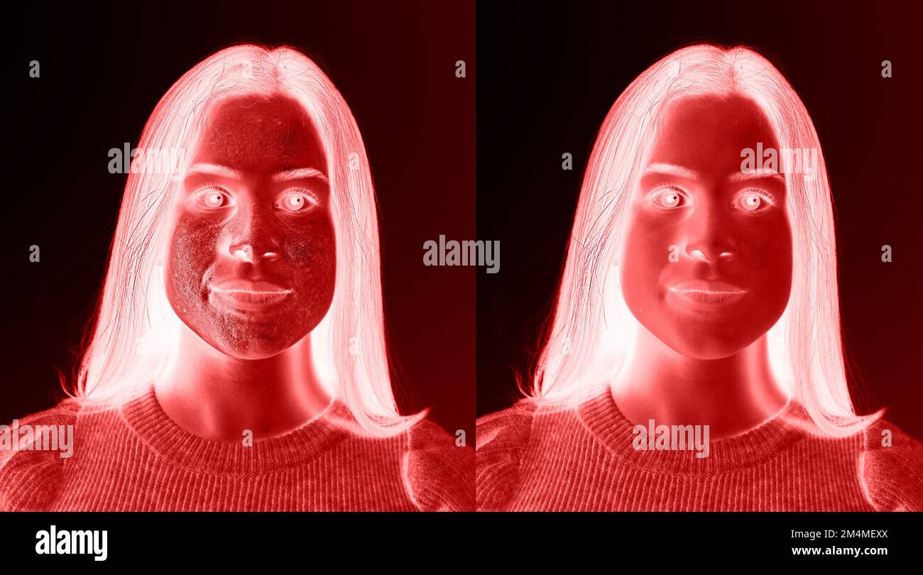 computerized view of a female face to show before and after rosacea ...