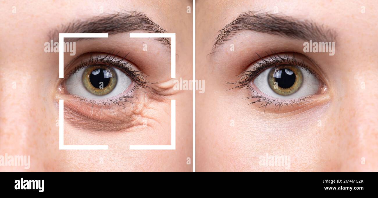 Collage from closeup views of women eyes. Comparison of before and ...