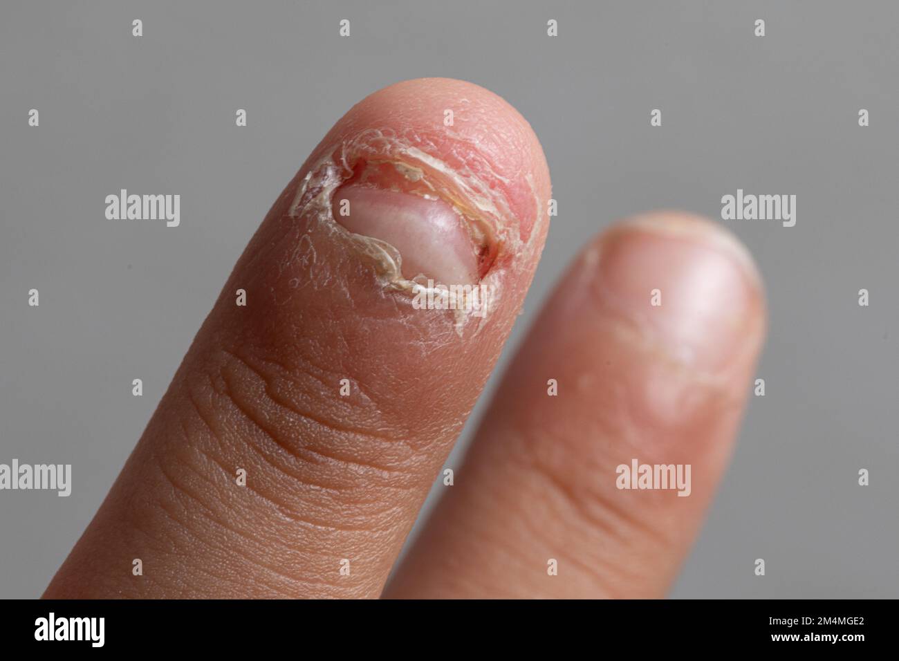 Macro view single finger nail damaged by infection soft focus ...
