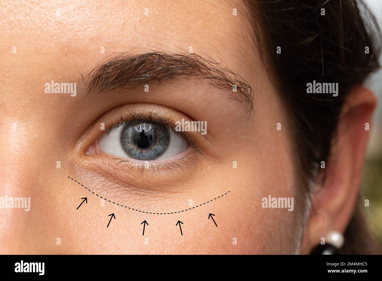 Closeup of a young woman's eye with lines and arrows for the correction ...