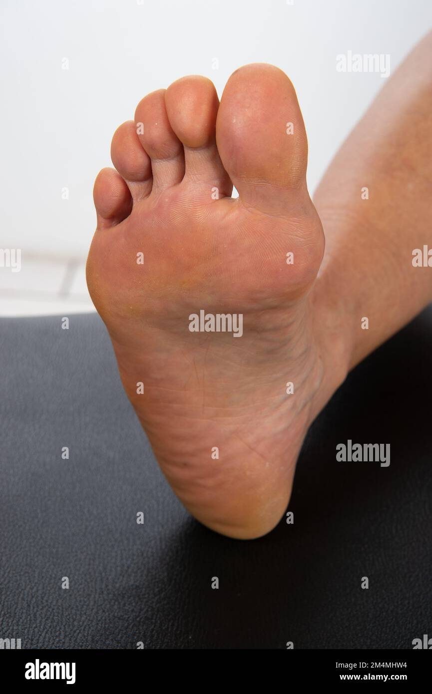 Foot of mature woman suffering from bunion during a hallux valgus ...