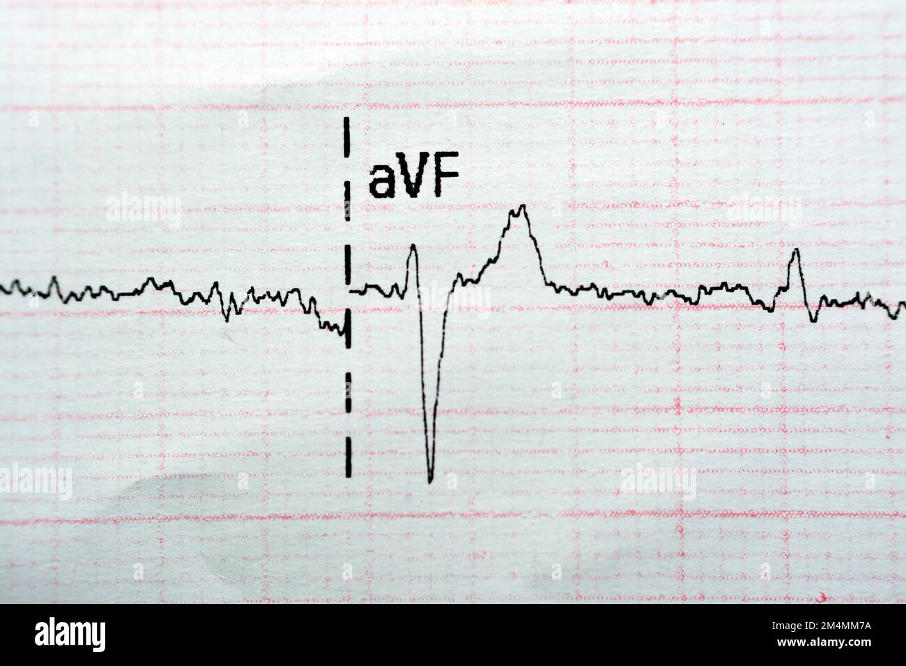 Premature Atrial Contraction Ventrcular Prematur Contractions, Sydney,