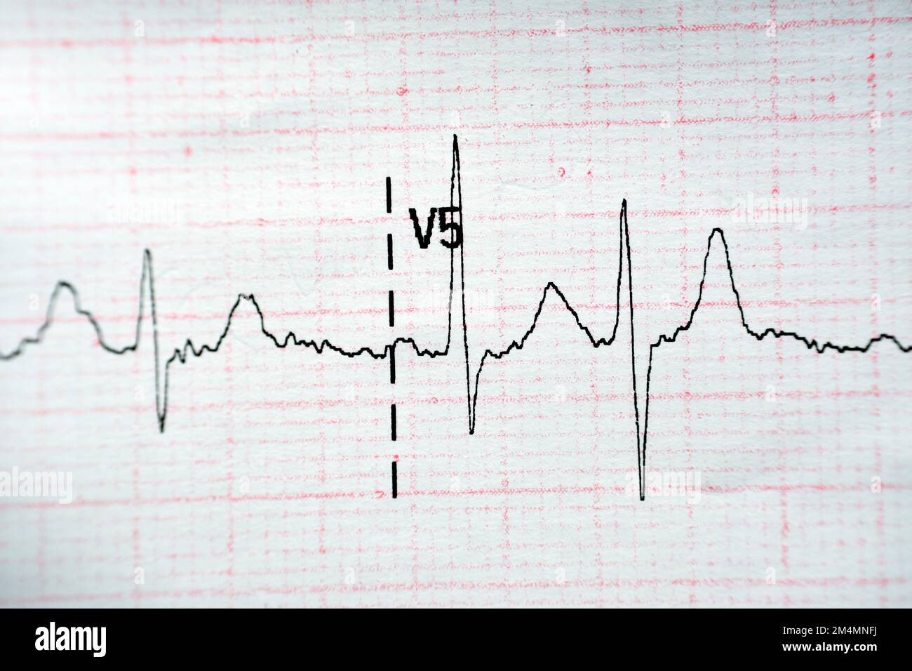 Premature Atrial Contraction Vs Premature Ventricular Contraction