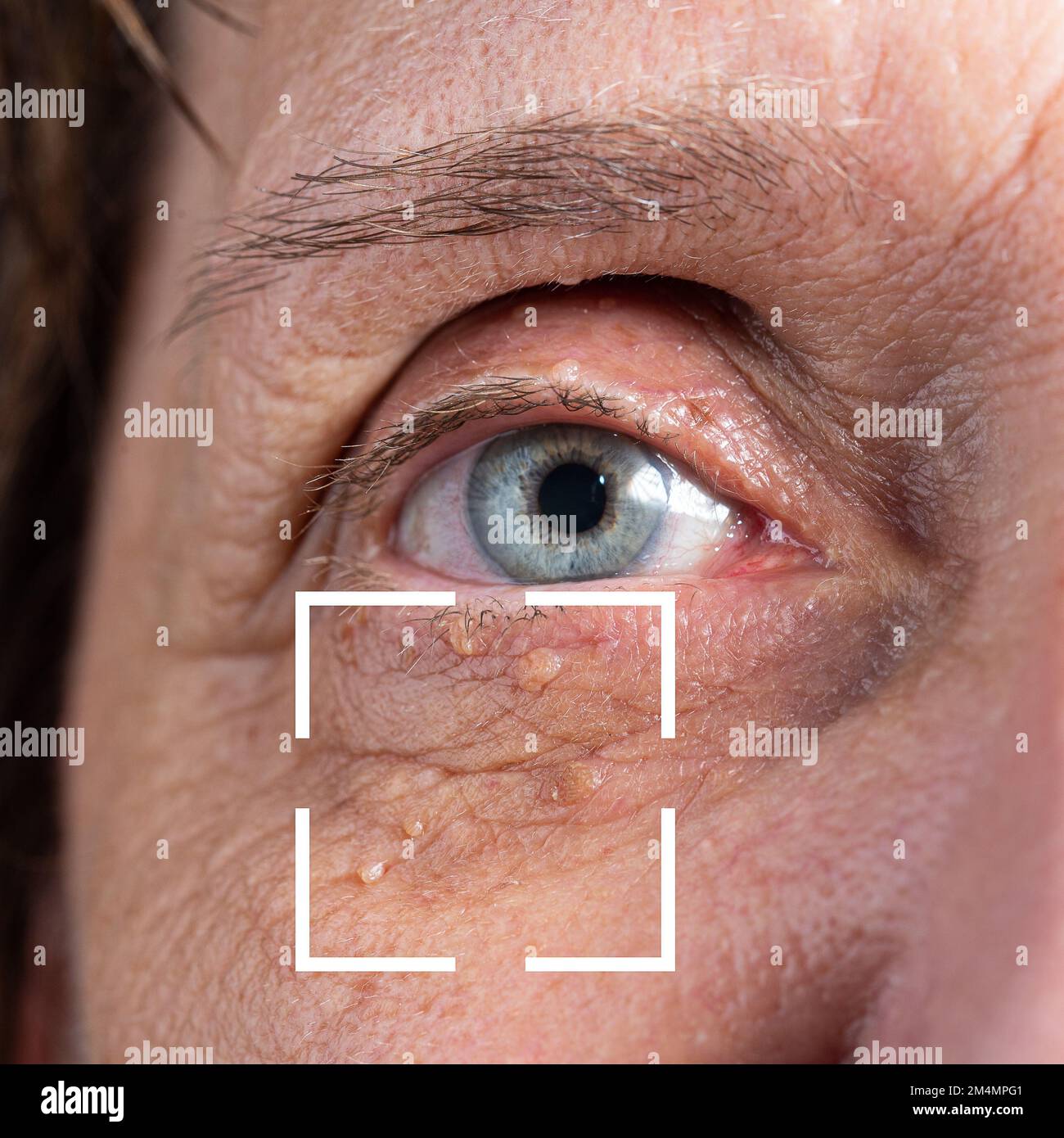 Elder lady's eye with wrinkles and angiomas on the eyelid highlighted ...