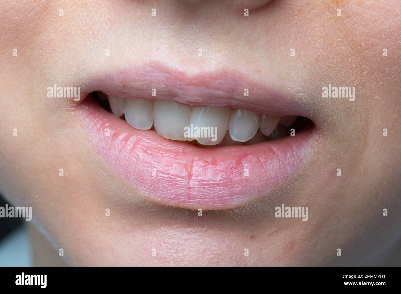 close-up photo of the front teeth or incisors that are not neat or ...