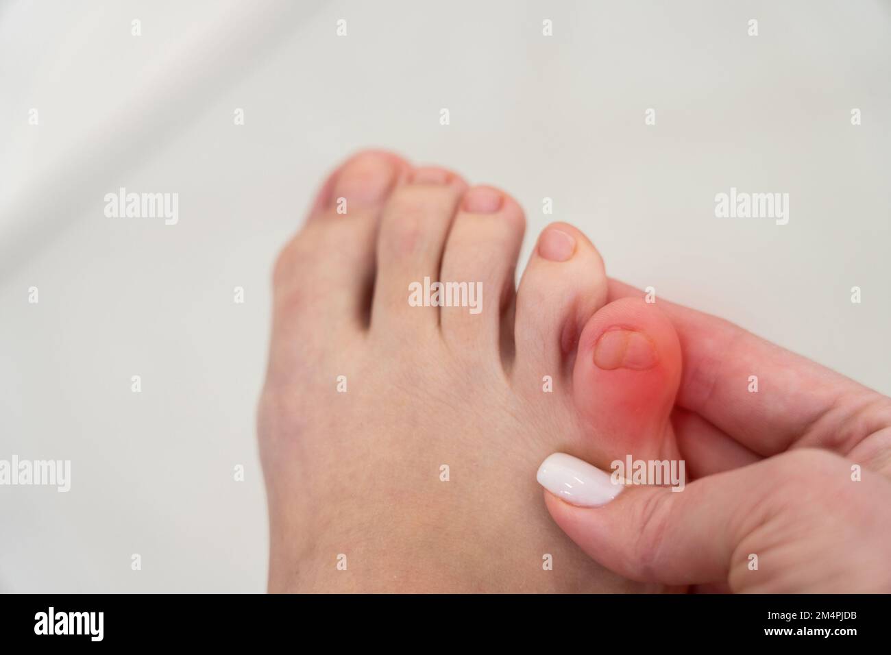 Inflammation on female foot with red spot. Concept of feet pain and ...