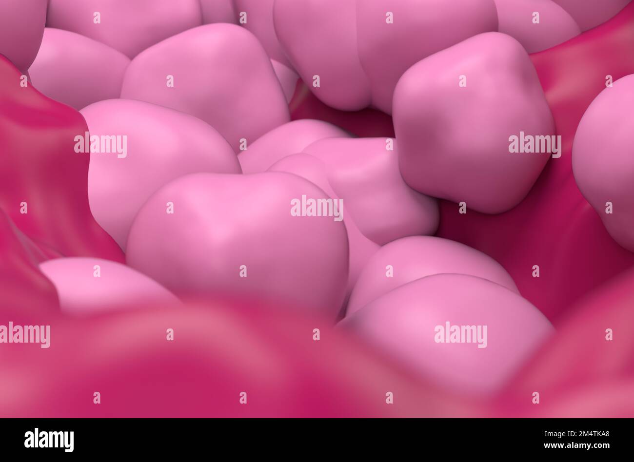 Non Small Cell Lung Cancer (NSCLC) in the lung tissue - super closeup ...