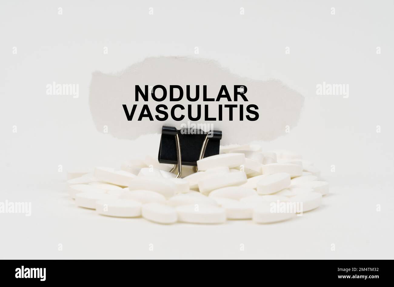 Nodular vasculitis hi-res stock photography and images - Alamy