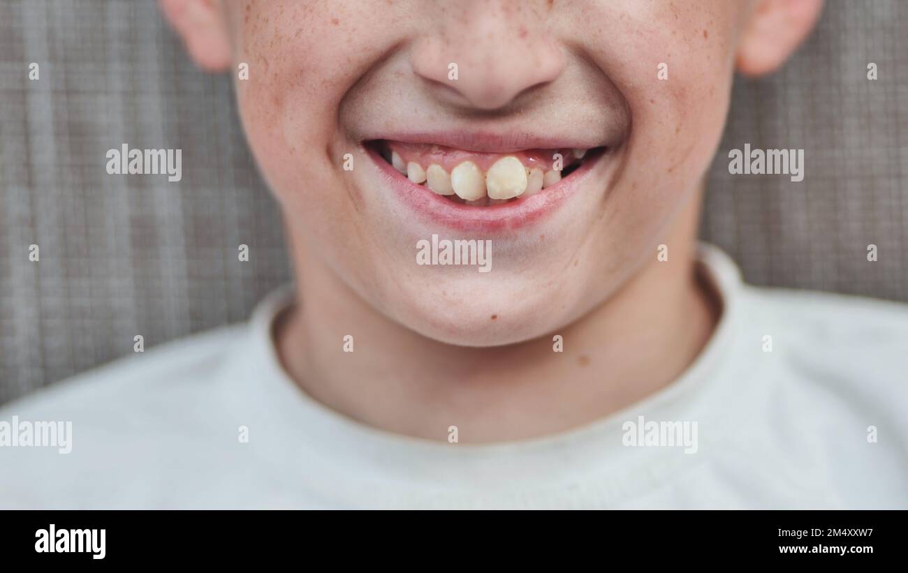 The boy's front crooked teeth Stock Photo - Alamy