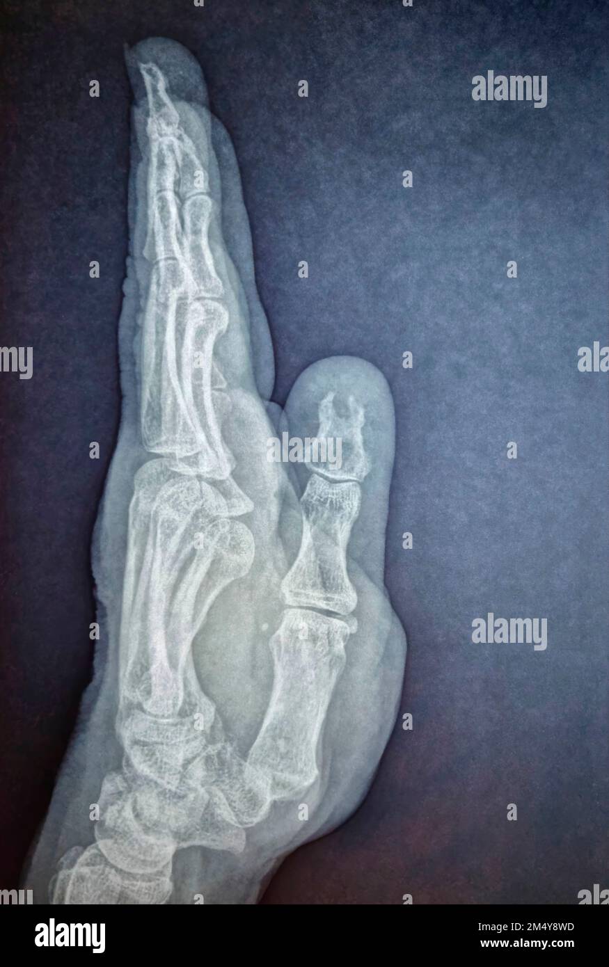 X-Ray of human hand, radiography of hand bones, infected bone in the ...