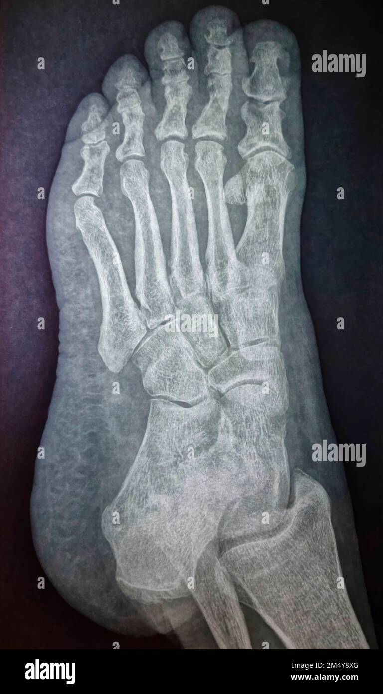 The Bend Of Leg And Foot X Ray