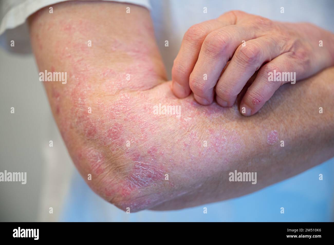 Itchy psoriasis on arm and hand Stock Photo - Alamy
