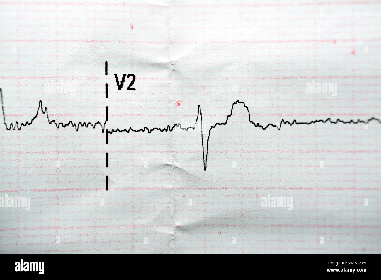 ECG ElectroCardioGraph paper that shows Normal Sinus Rhythm NSR with ...
