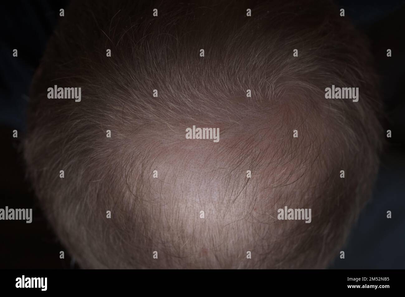 Male androgenetic alopecia hi-res stock photography and images - Alamy