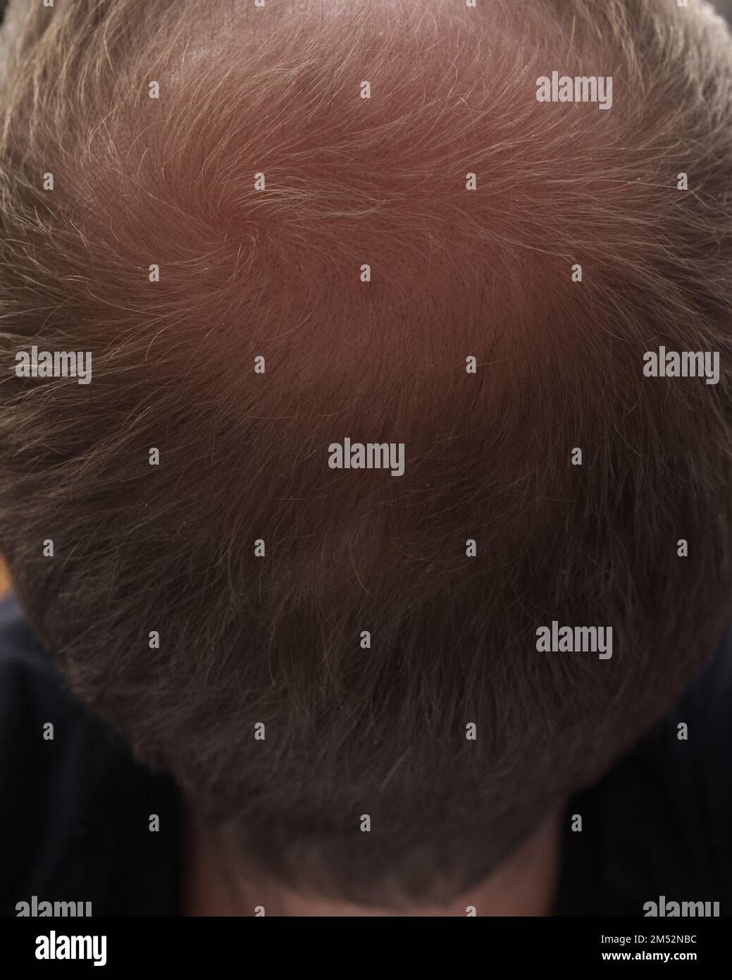 Telogen alopecia hi-res stock photography and images - Alamy