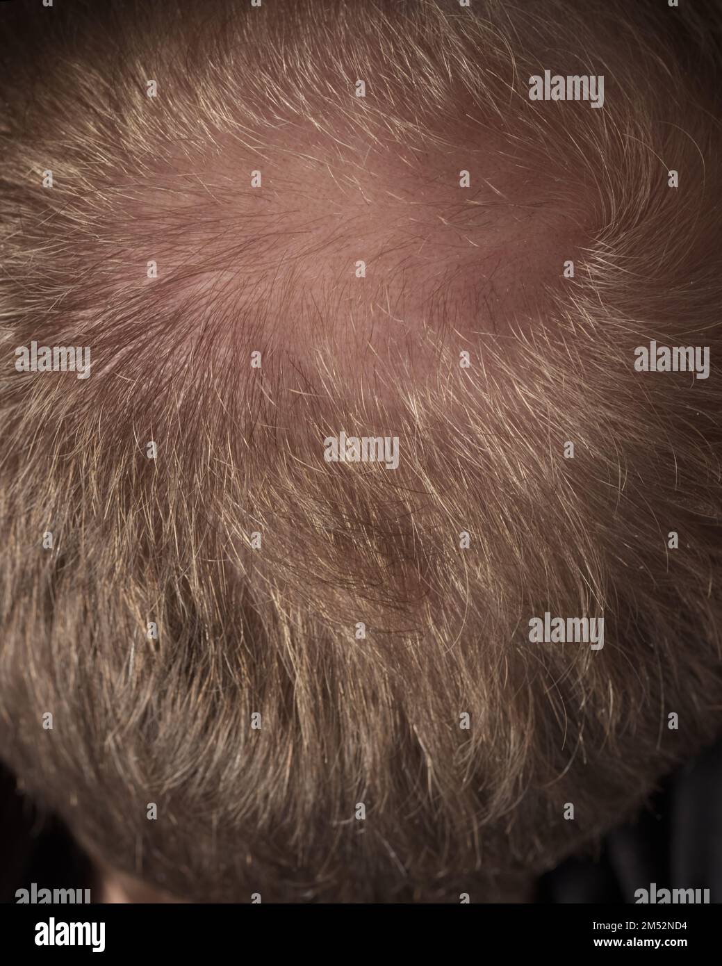 Men hair loss problem alopecia, closeup shallow focus photo Stock Photo ...