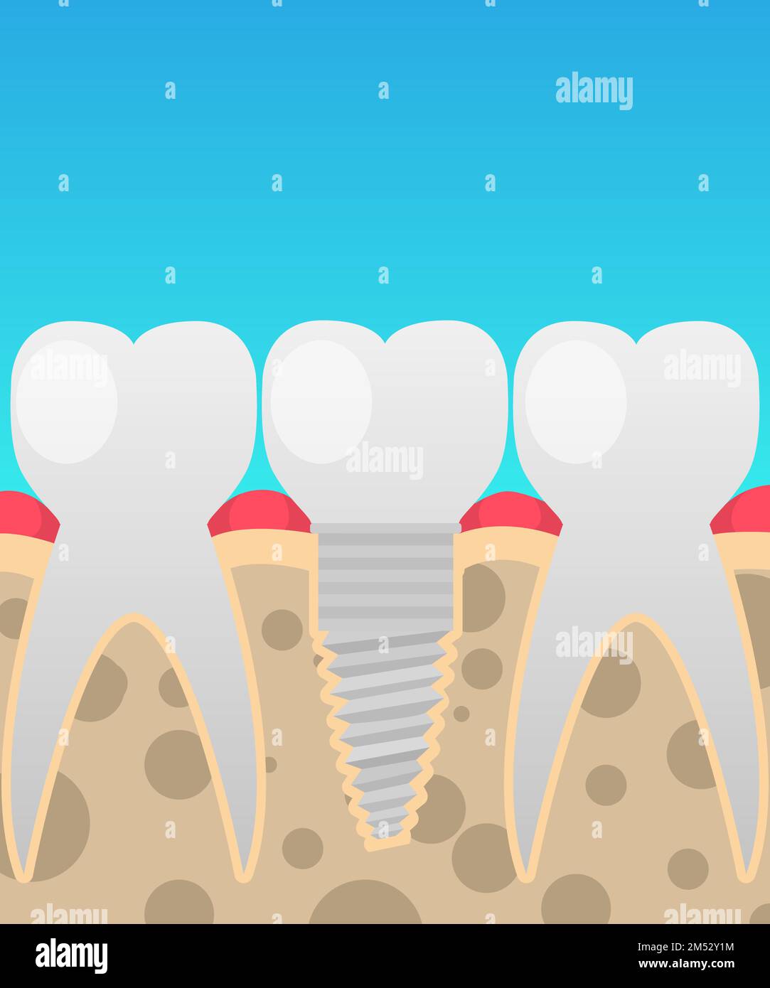Dental implants, tooth replacement, vector illustration in a cartoon ...