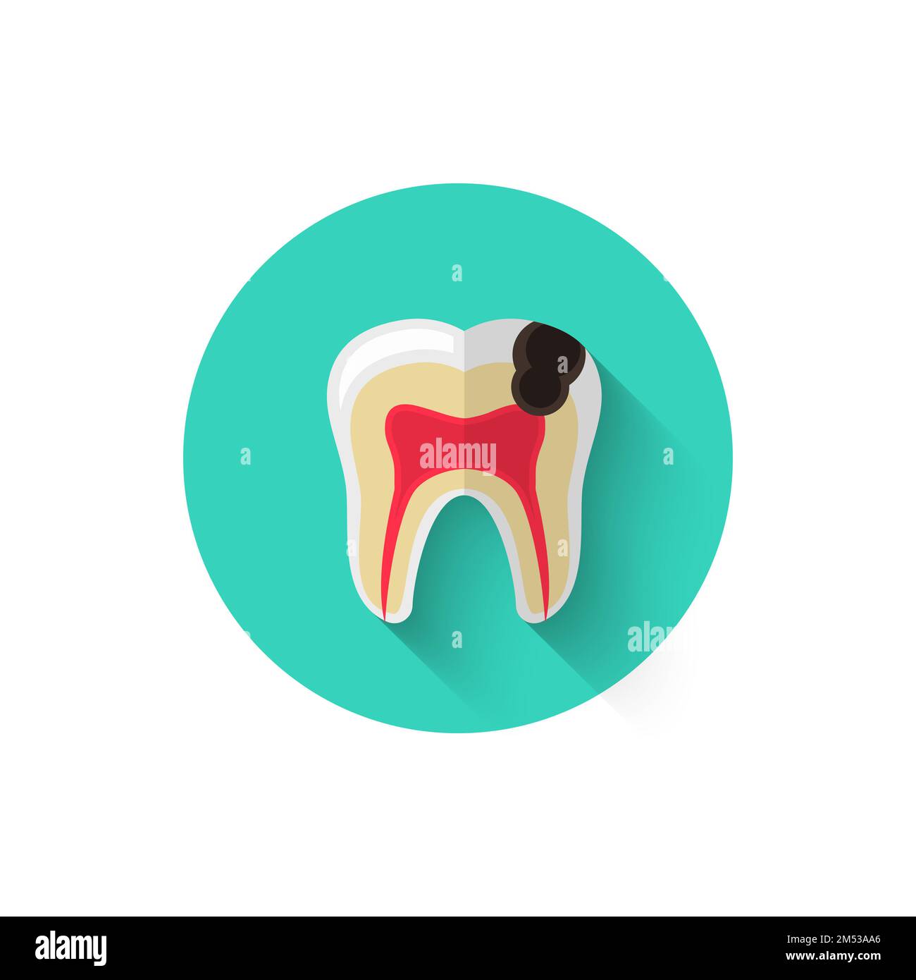 Tooth decay, caries illustrated in a flat style design of vector ...