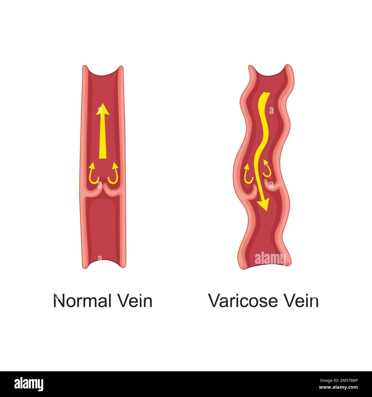 Varicose Vein Scientific Design. Colorful Symbols. Vector Illustration ...