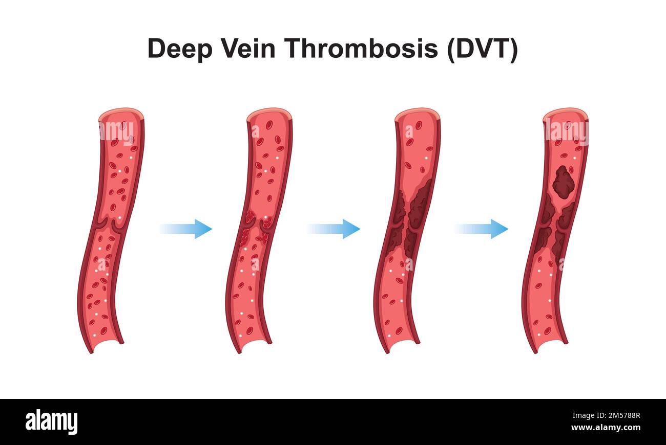 Deep vein thrombosis infographic hi-res stock photography and images ...