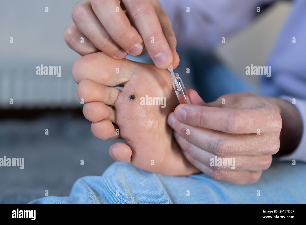 Verruca foot hi-res stock photography and images - Alamy