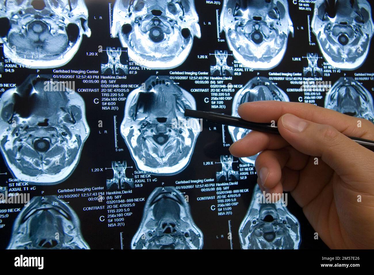Mri of neck hi-res stock photography and images - Alamy