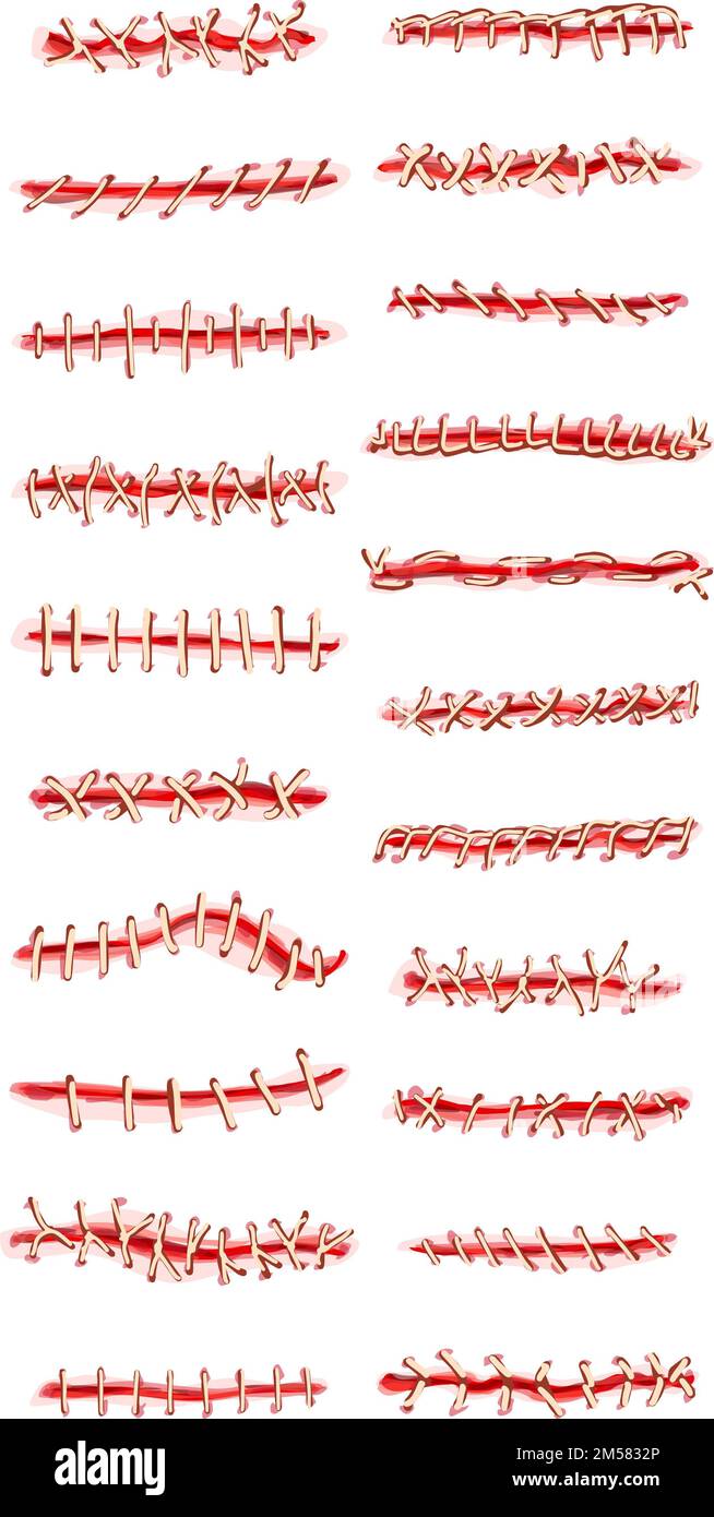Suture icons set cartoon vector. Wound surgical. Doctor laceration Stock Vector Image & Art - Alamy