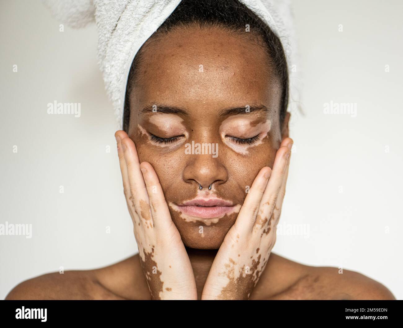 Portrait of young Brazilian woman with Vitiligo on face and hands ...