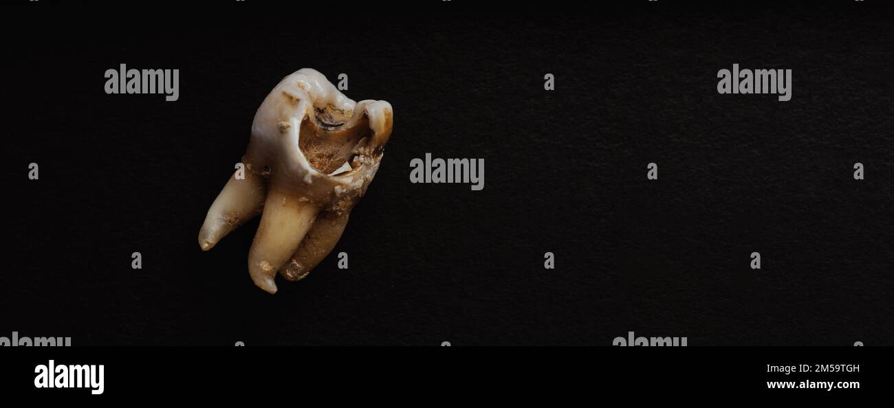 Tooth decay on black background. Macro shot of a decayed teeth till ...
