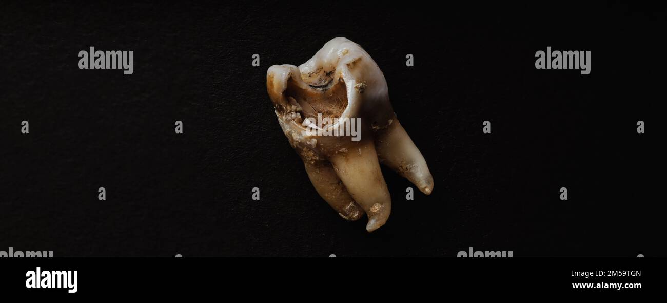 Tooth decay on black background. Macro shot of a decayed teeth till ...