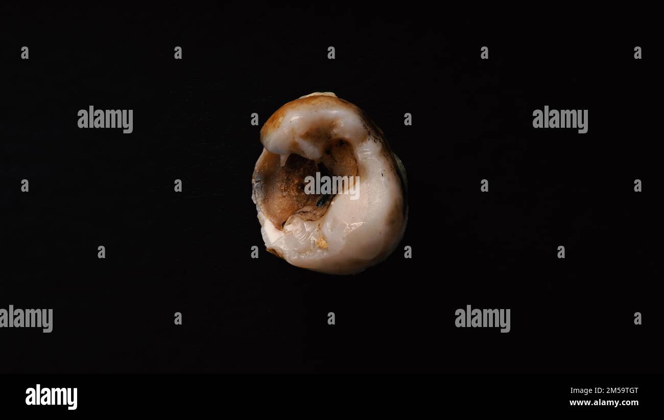 Tooth decay on black background. Macro shot of a decayed teeth till ...