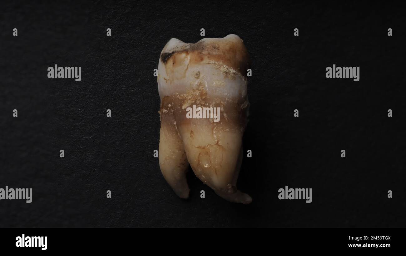 Tooth decay on black background. Macro shot of a decayed teeth till ...