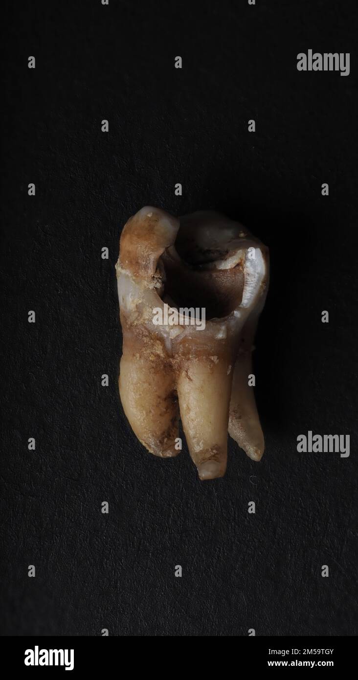 Tooth decay on black background. Macro shot of a decayed teeth till ...