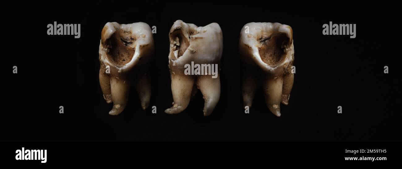 Tooth decay on black background. Macro shot of a decayed teeth till ...