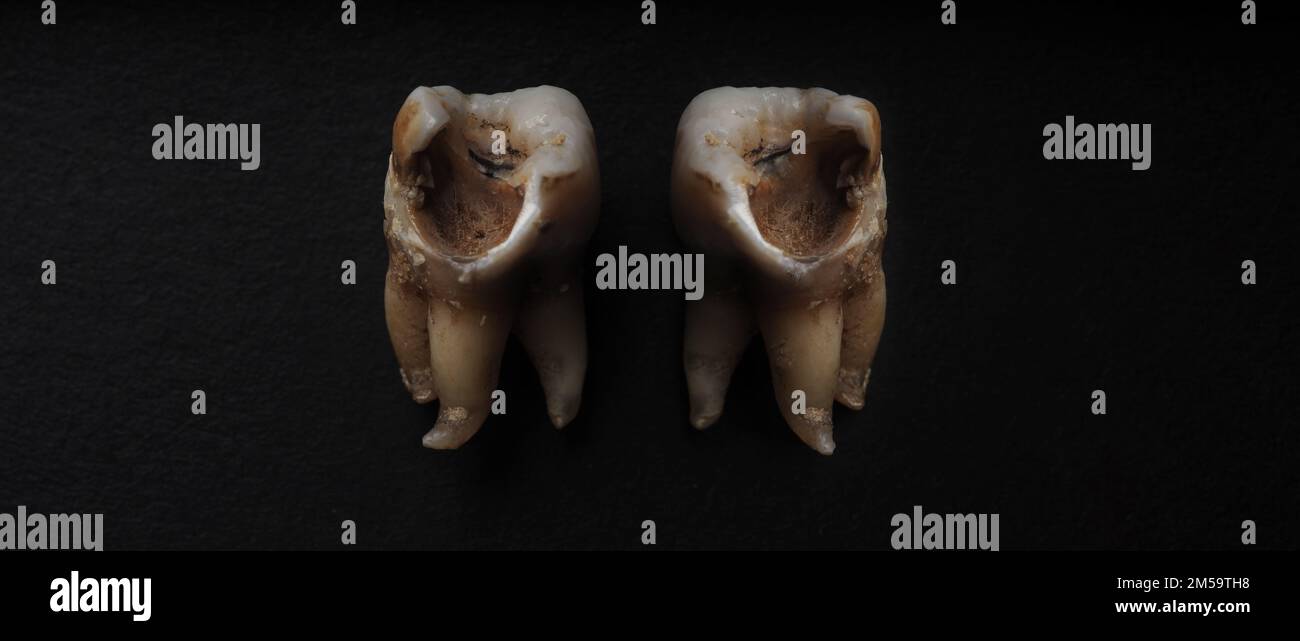 Tooth decay on black background. Macro shot of a decayed teeth till ...