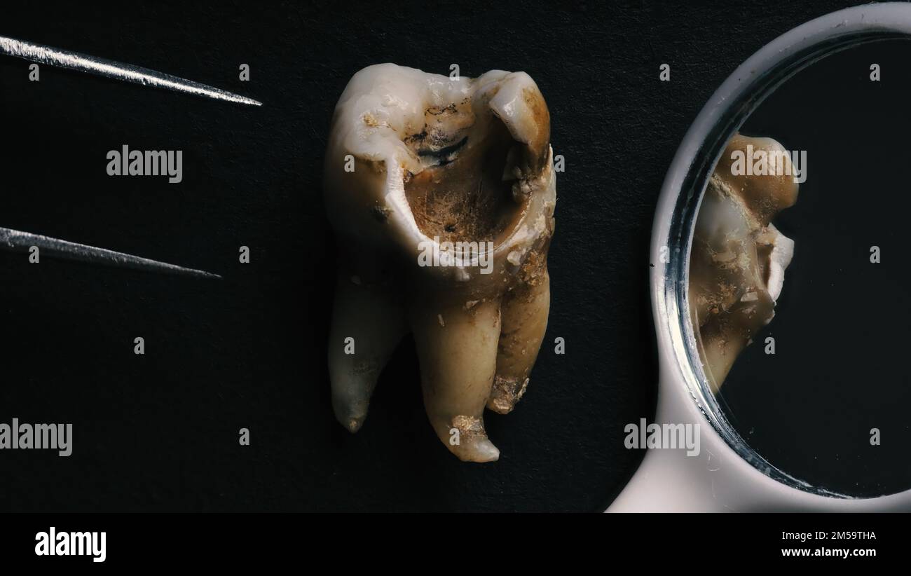 Tooth decay on black background. Macro shot of a decayed teeth till ...