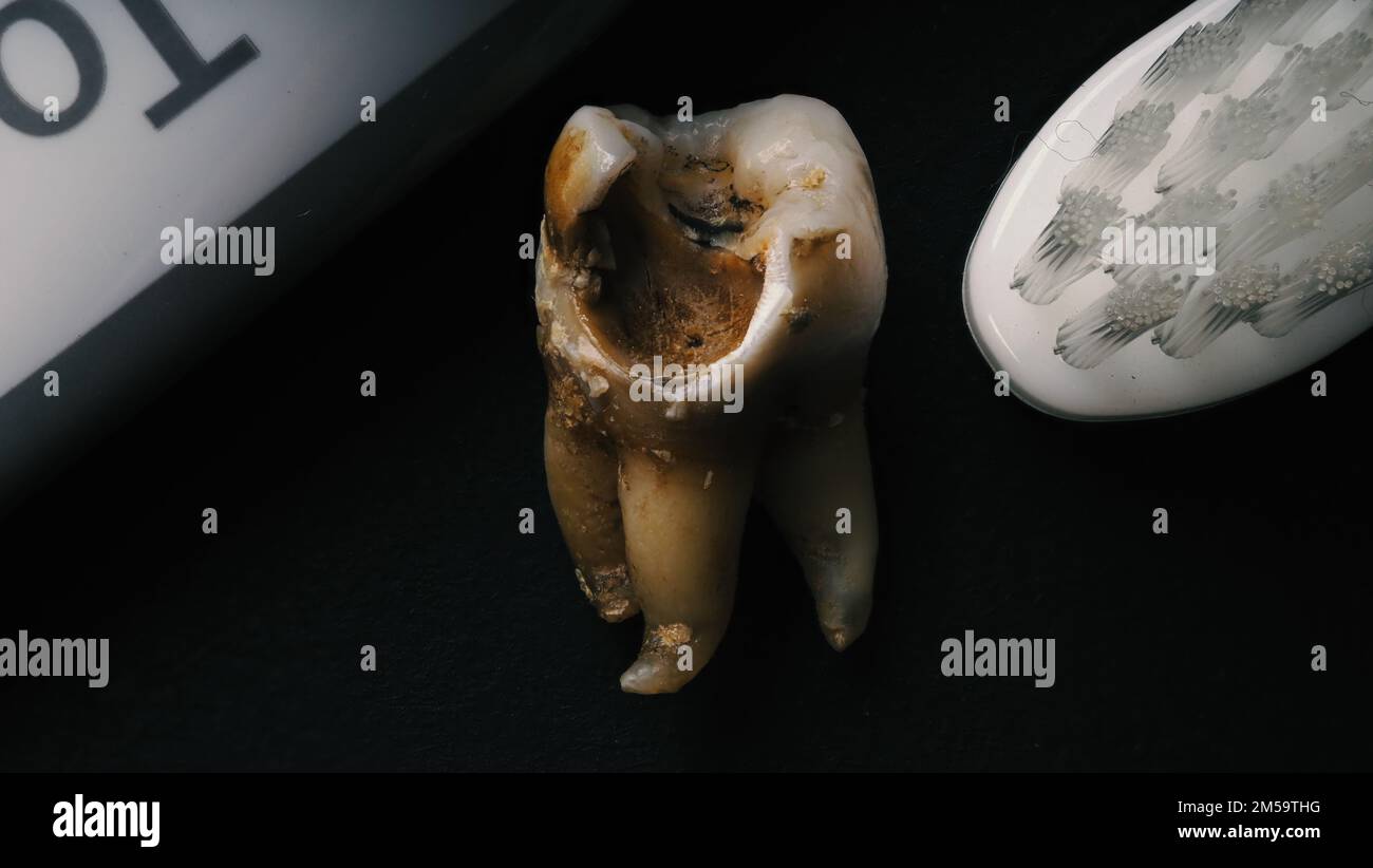 Tooth decay on black background. Macro shot of a decayed teeth till ...