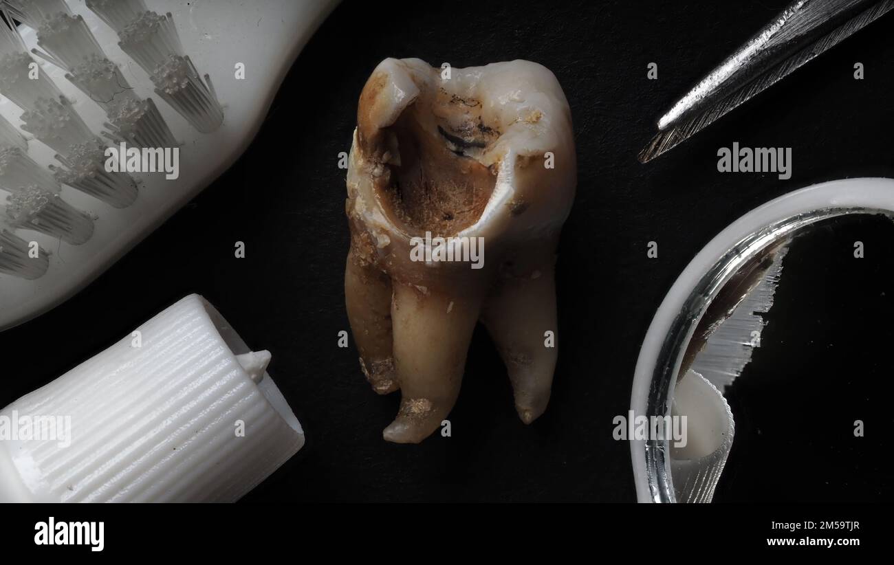 Tooth decay on black background. Macro shot of a decayed teeth till ...