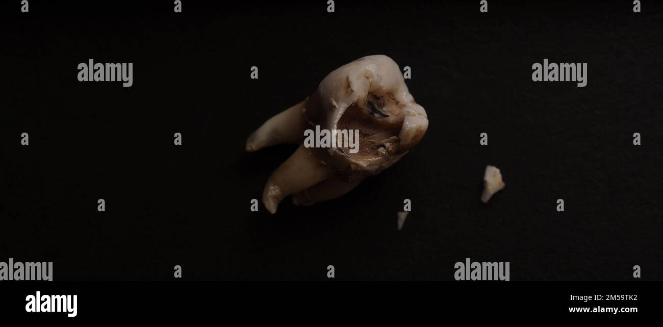 Tooth decay on black background. Macro shot of a decayed teeth till ...
