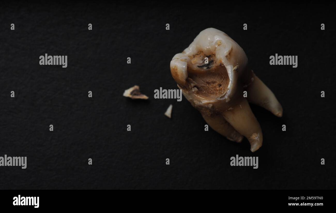Tooth decay on black background. Macro shot of a decayed teeth till ...