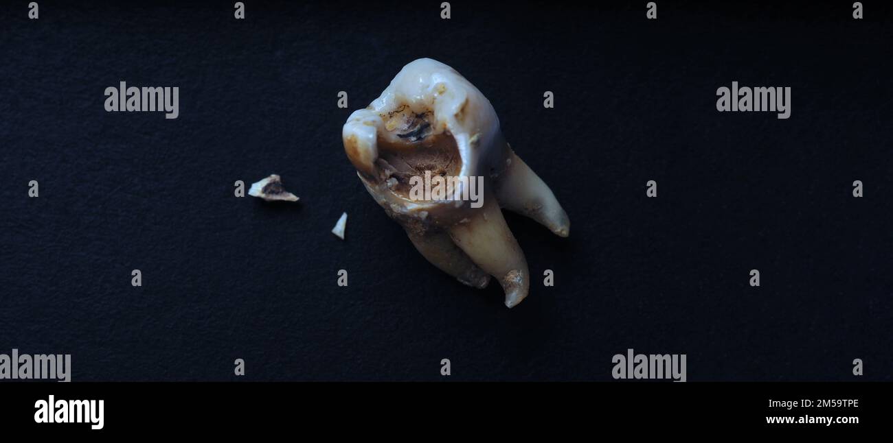 Tooth decay on black background. Macro shot of a decayed teeth till ...
