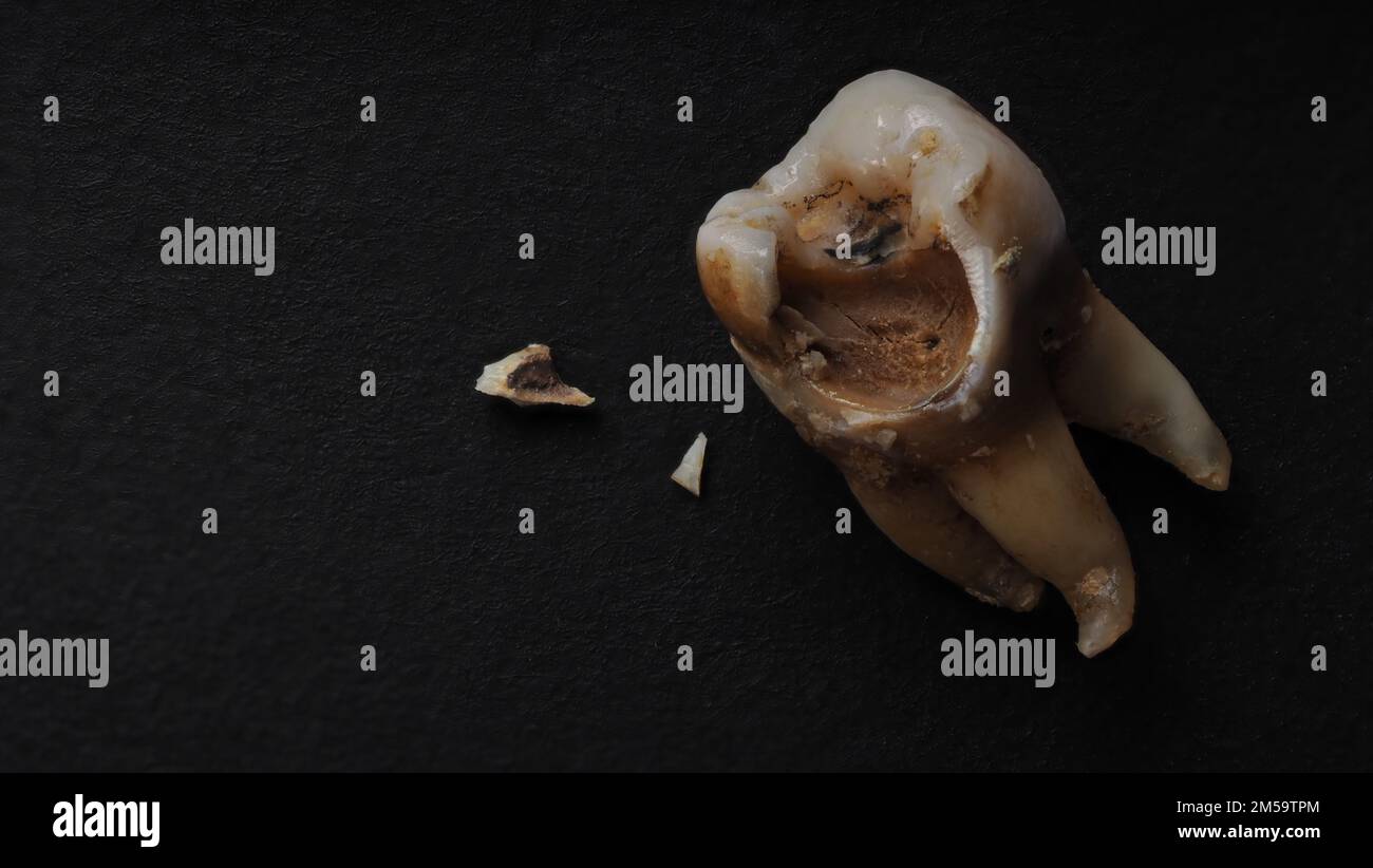 Tooth decay on black background. Macro shot of a decayed teeth till ...